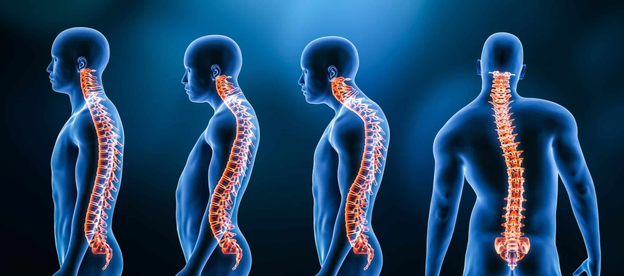 The Kyphosis Learning Curve: How to Exercise and What Moves to Avoid